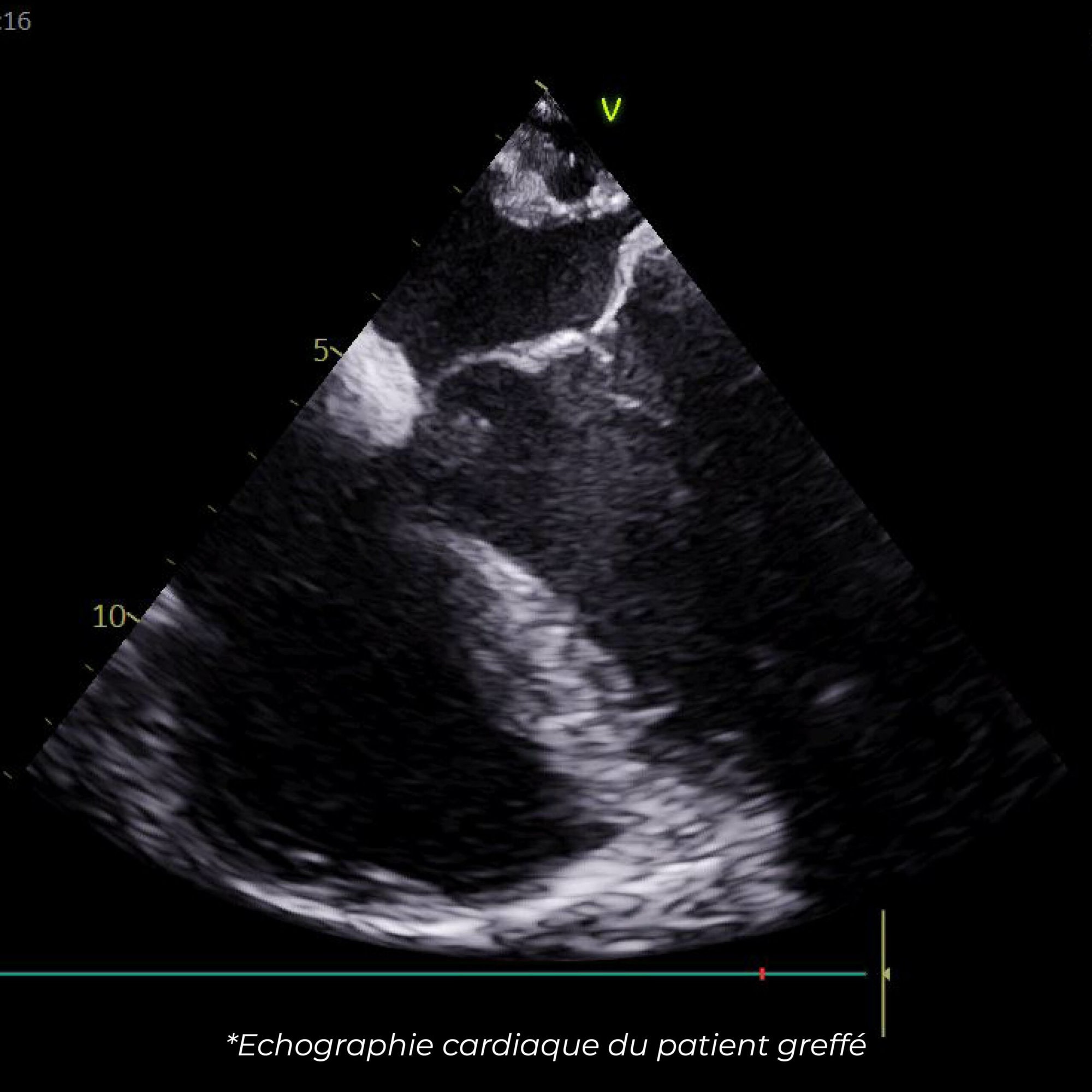 Innovation en Transplantation cardiaque - Fondation Hôpital Saint-Joseph